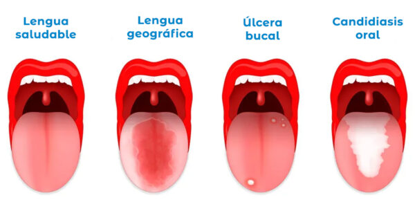 Patología Oral: posibles lesiones y enfermedades de la boca – Clínica ...